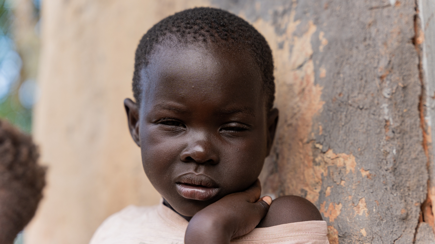 Trachoma and trichiasis: causes, symptoms and treatment | Sightsavers